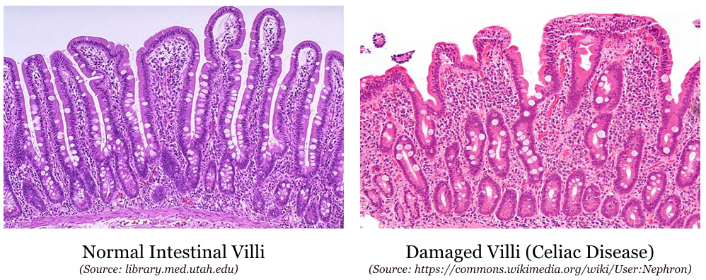 Why Many Celiacs Don't Completely Heal On A Gluten Free Diet - Gluten ...